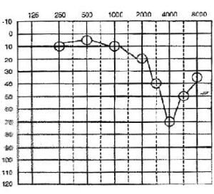 Pure Tone Audiogram: Symbols | Configuration | Interpretation
