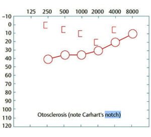 Pure Tone Audiogram: Symbols | Configuration | Interpretation