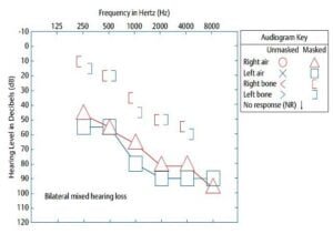 Pure Tone Audiogram: Symbols | Configuration | Interpretation
