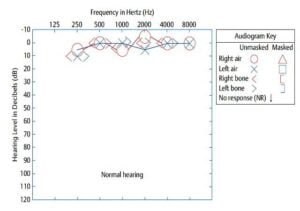Pure Tone Audiogram: Symbols | Configuration | Interpretation