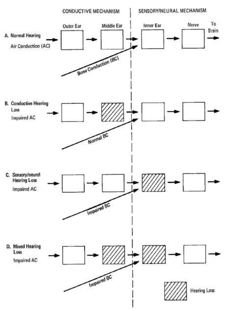 What is Hearing Loss and its type?